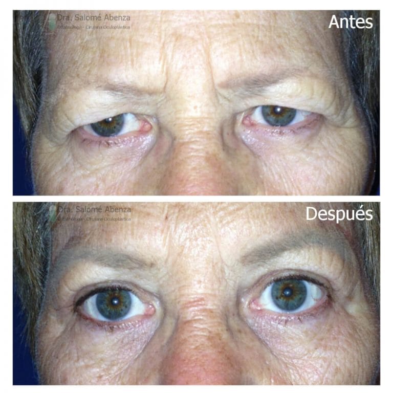 Entropion senil del párpado inferior izquierdo tratado mediante ...