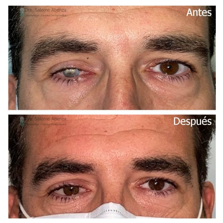 Evisceración en ojo derecho por traumatismo, prótesis externa definitiva.